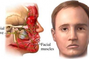 What is facial paralysis?